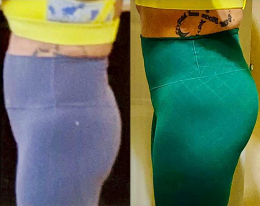 Db Method Before And After Cellulite
