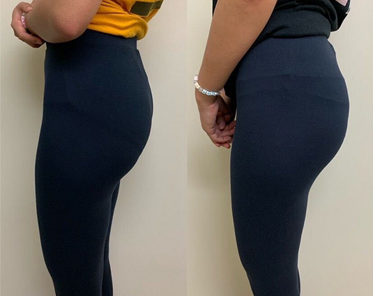Db Method Before And After Cellulite
